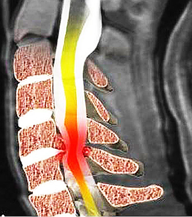Cambios cerebrales por la compresión medular | DiarioMedico