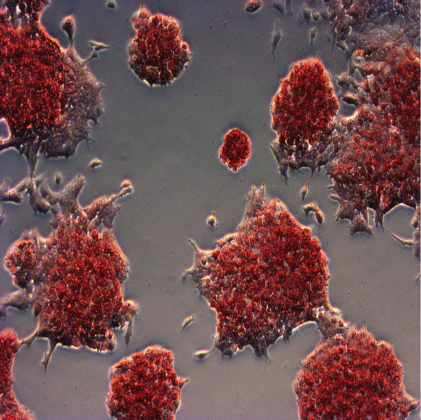 La grasa periprostática interviene en el tumor | DiarioMedico