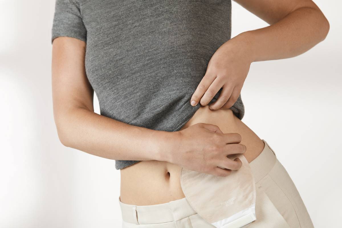 Las enfermeras estomaterapeutas presentan el primer 'lipdub' de ostomía ...