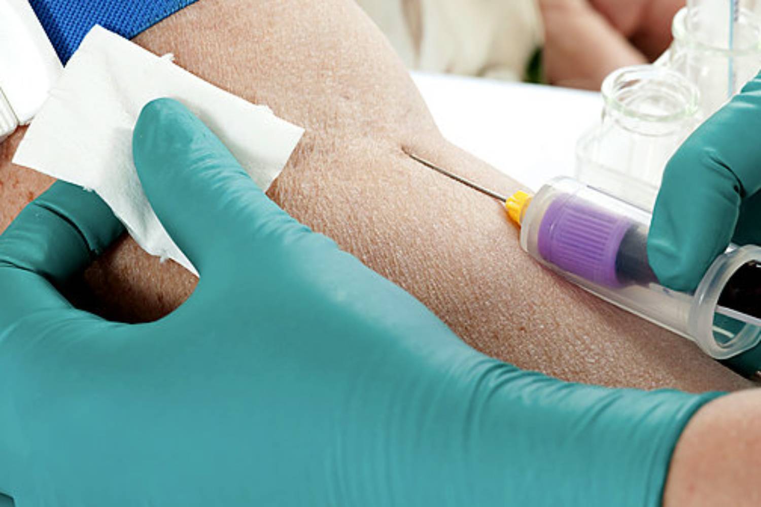 AstraZeneca apuesta 2.000 millones por la Lp(a)