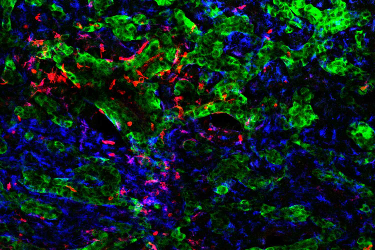 Hallan una potencial diana terapéutica en metástasis cerebral