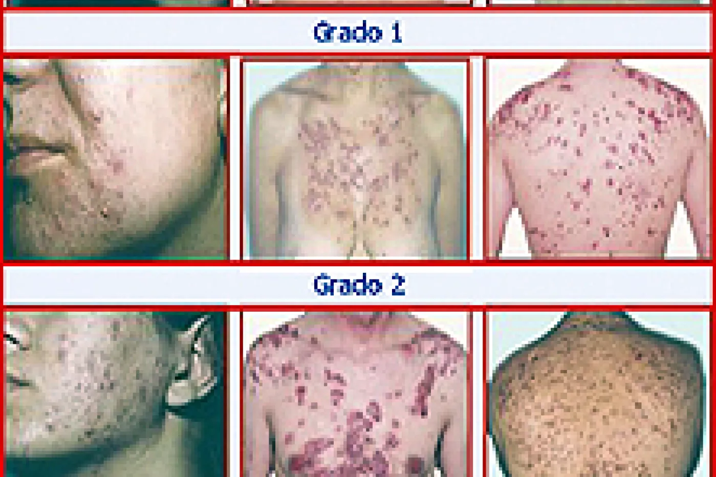 Una nueva escala española valora la gravedad del acné | DiarioMedico