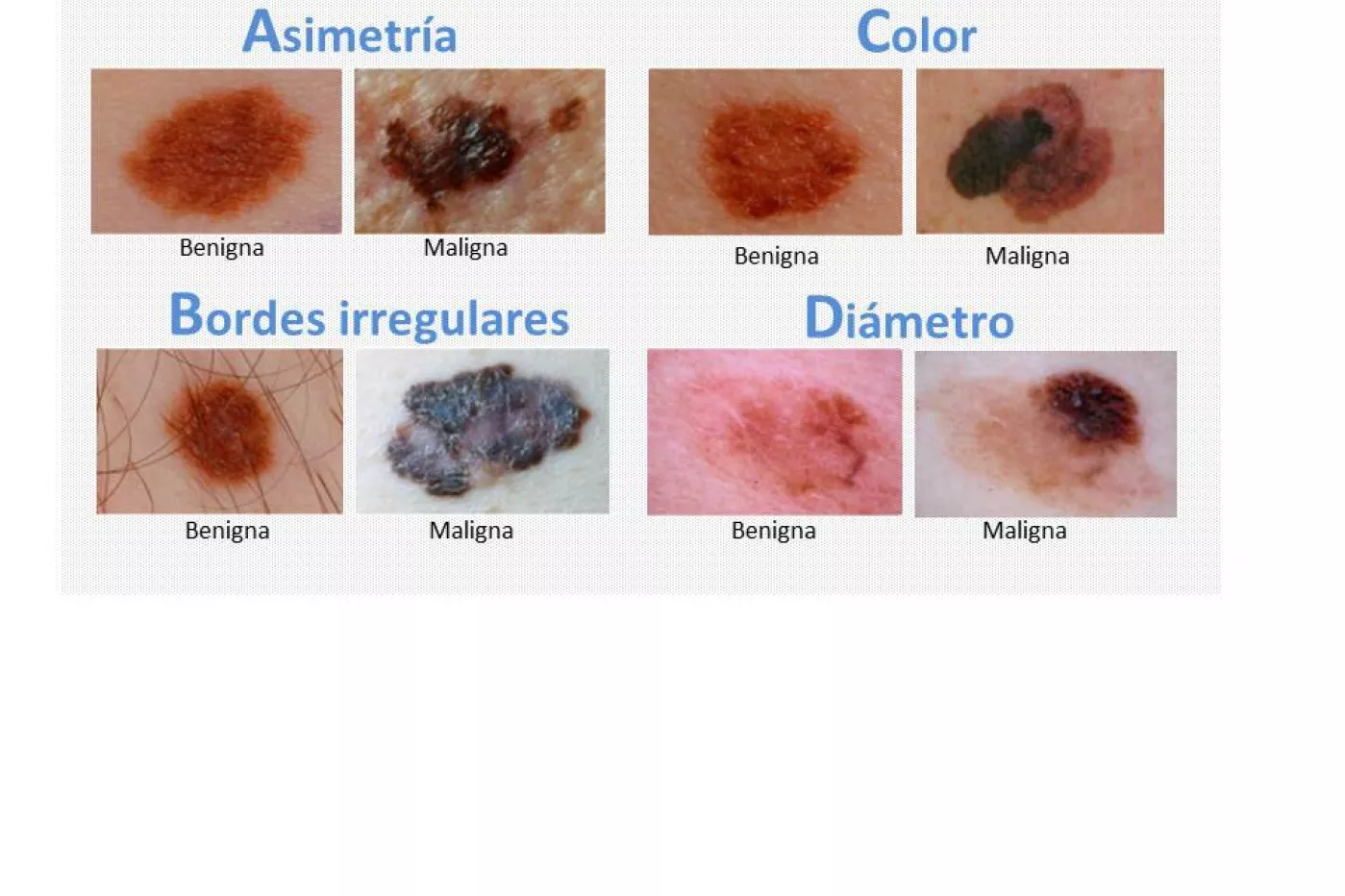 El juego del ABCDE del melanoma para mejorar el diagnóstico precoz ...