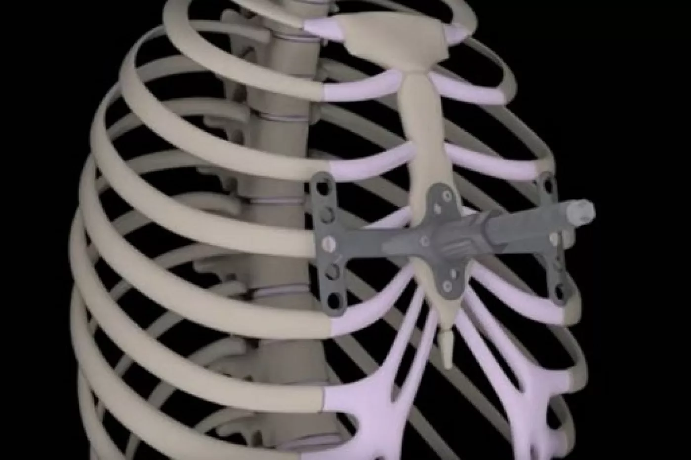 'Pectus-up', nueva técnica mínimamente invasiva para 'pectus excavatum ...