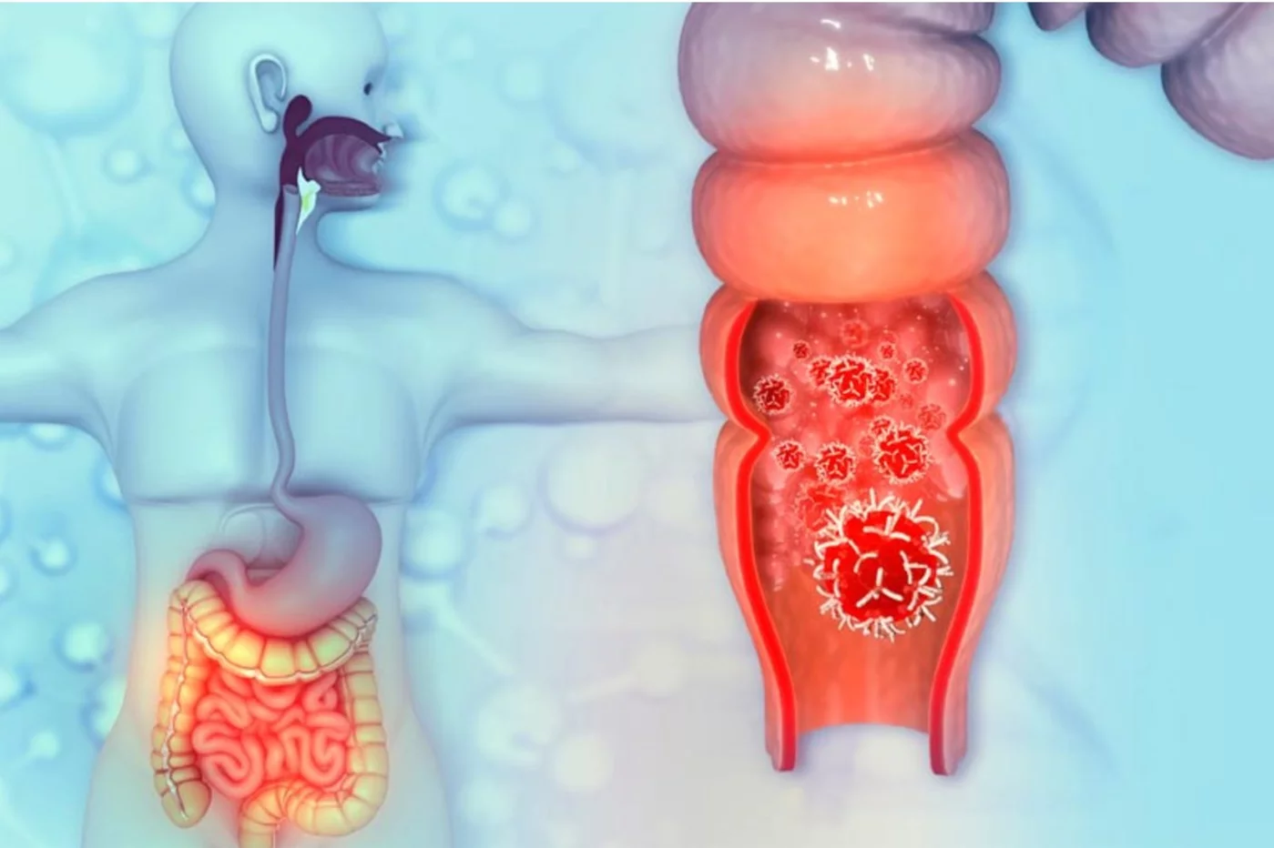 Nuevo estándar en cáncer rectal con alto riesgo de recaída | DiarioMedico